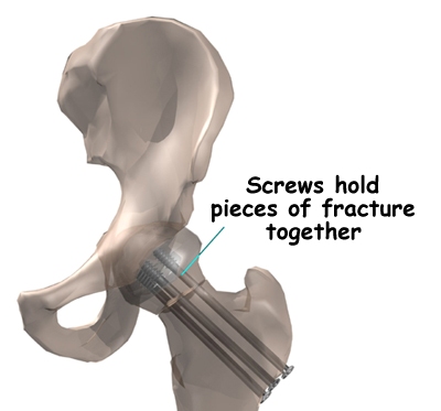Treatment for hip fracture - Orthopedic Surgeon For Hip, Knee Surgeries ...